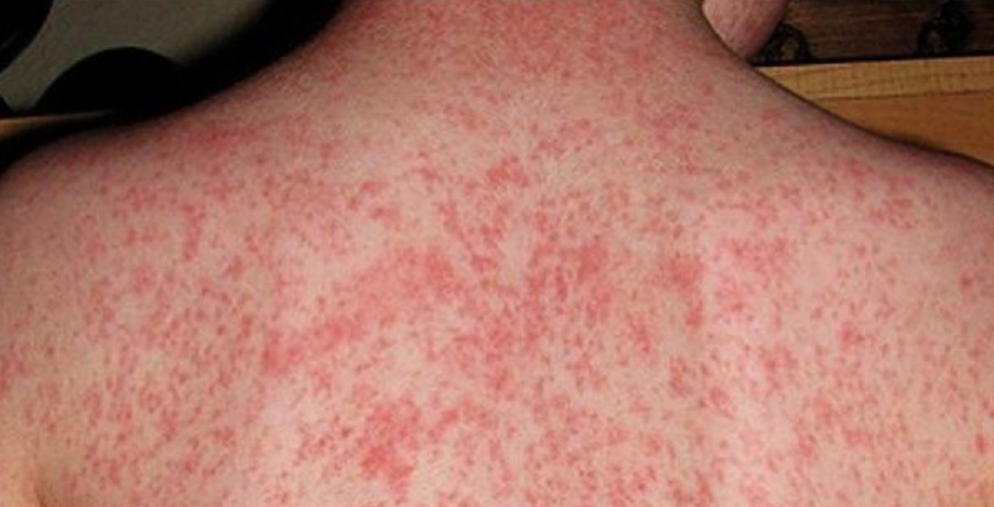 Casos de sarampión se han triplicado en el mundo, alerta OMS - Segundo ...